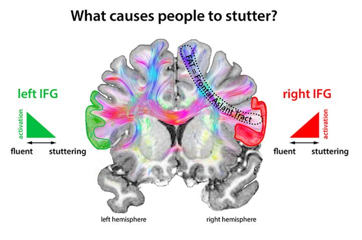 Why We Stutter: Right Brain Activity Halts Left's, Study Shows | American Council on Science and ...